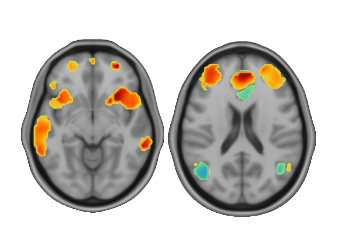 Precision Mental Health - fMRI Guided Transcranial Magnetic Stim