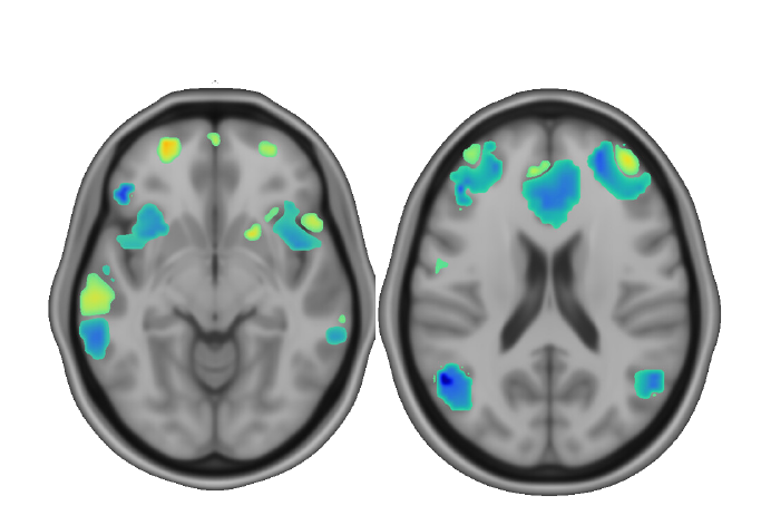 Precision Mental Health - fMRI Guided Transcranial Magnetic Stim